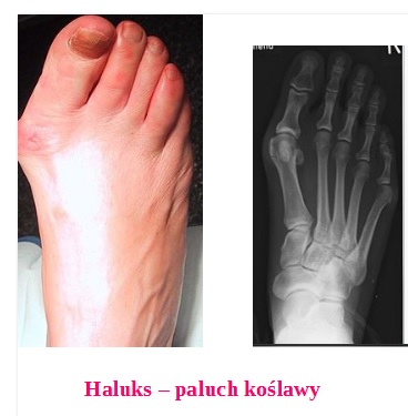Jak walczyć z haluksami?